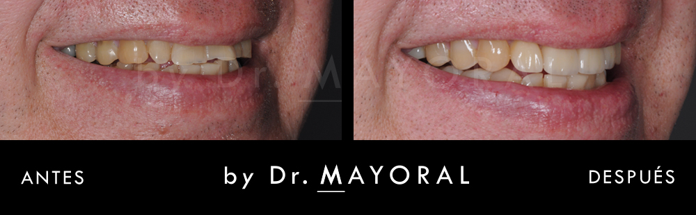 Dientes cortos o desgastados - Barcelona Smile Center