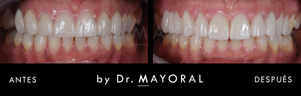 Dientes cortos y ausencia dental - Barcelona Smile Center