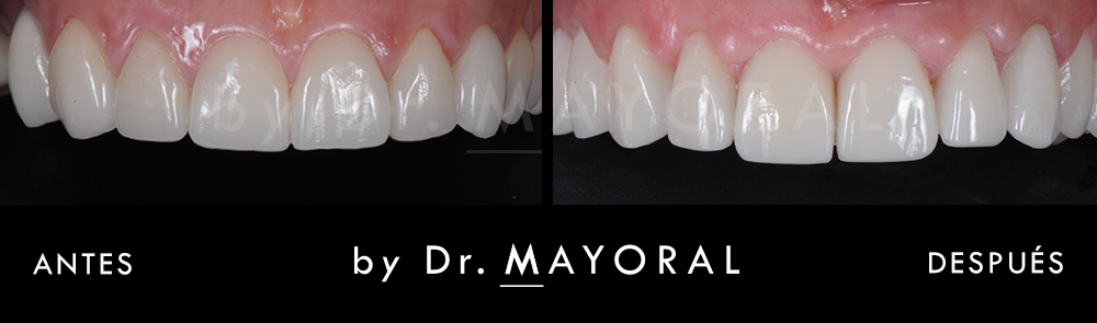 Dientes cortos y ausencia dental - Barcelona Smile Center