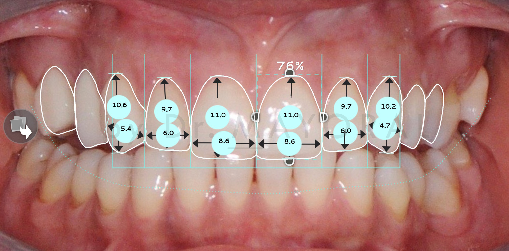 Dientes cortos y ausencia dental - Barcelona Smile Center