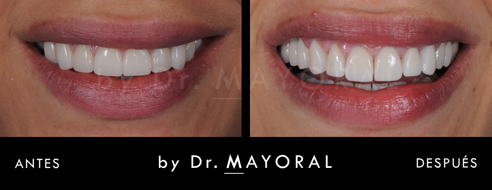 Dientes cortos y ausencia dental - Barcelona Smile Center