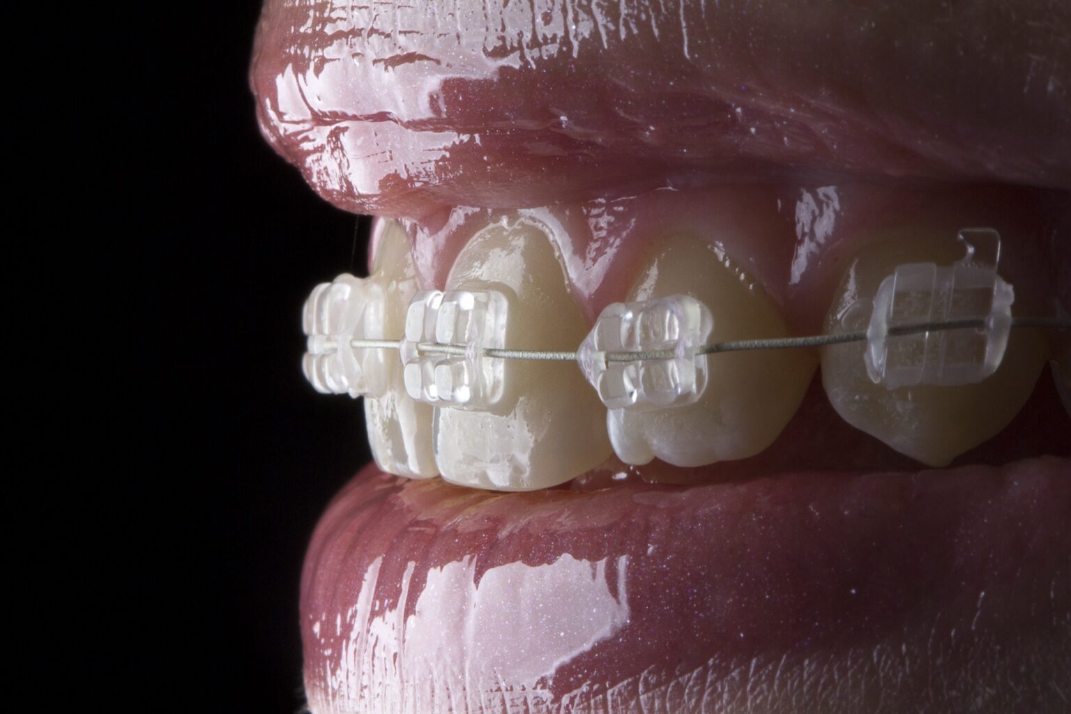 Ortodoncia - Barcelona Smile Center